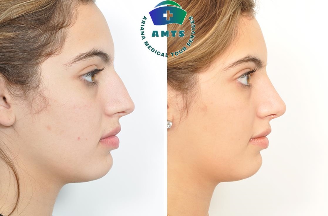 Rhinoplasty in Iran - Shiraz, Tehran, Mashhad | Best doctors, cost ...